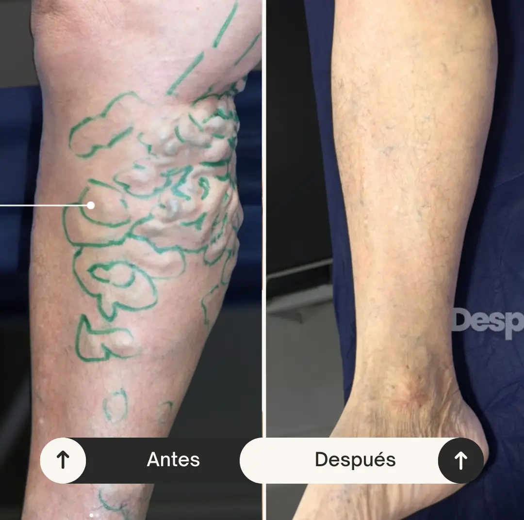 Curso de laser endovenoso - LaserLAB Dr. Ernesto Nieves