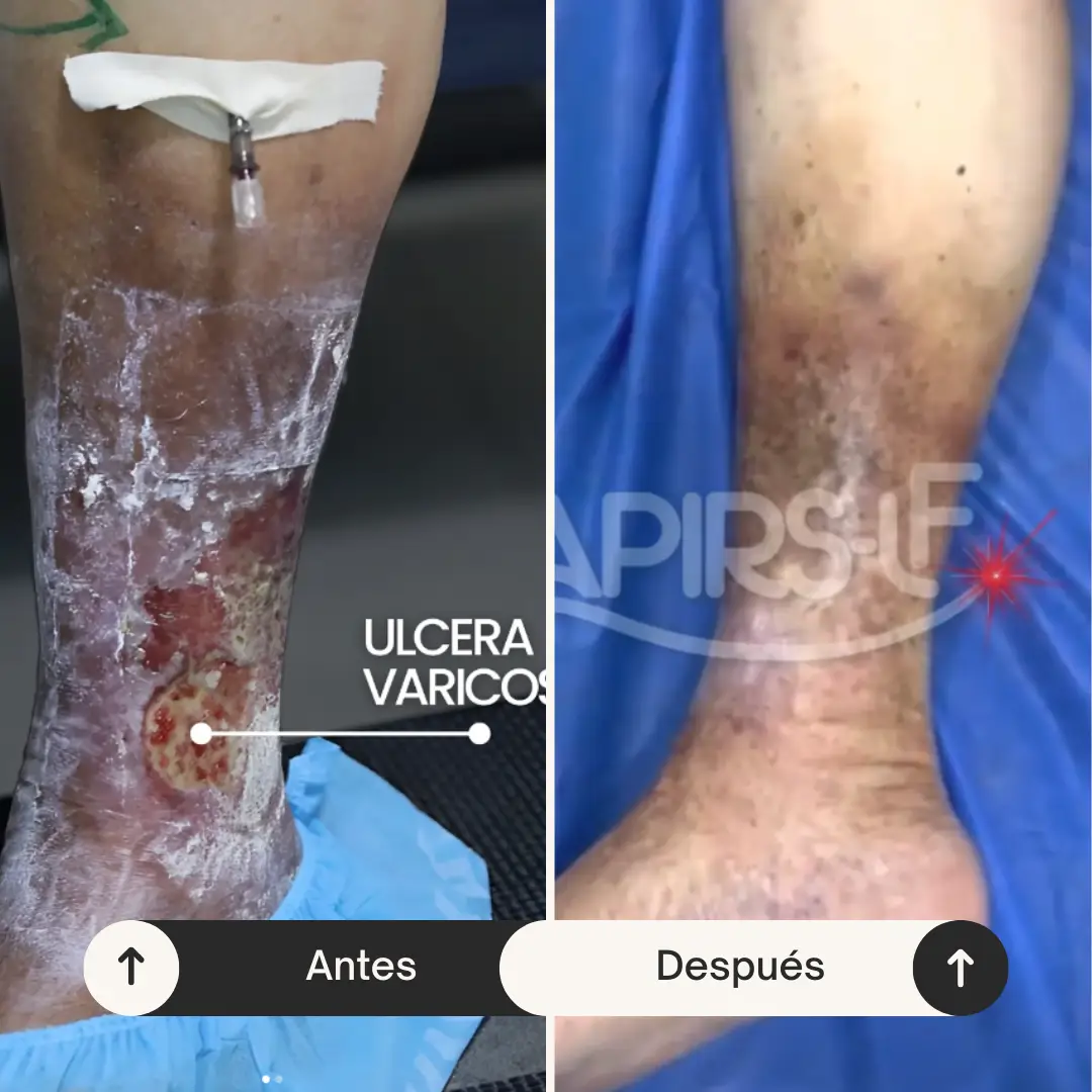 Curso de laser endovenoso - LaserLAB Dr. Ernesto Nieves